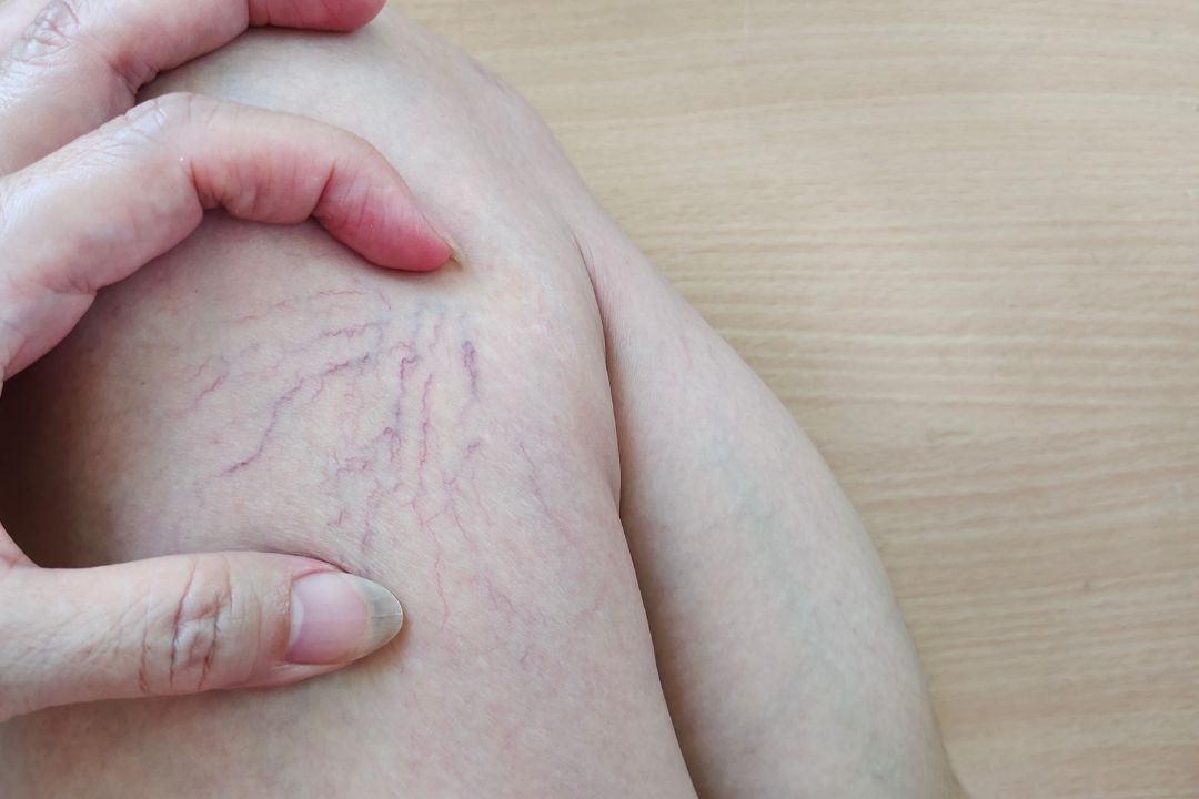 Check Your Veins: Simple Steps to Monitor Veins